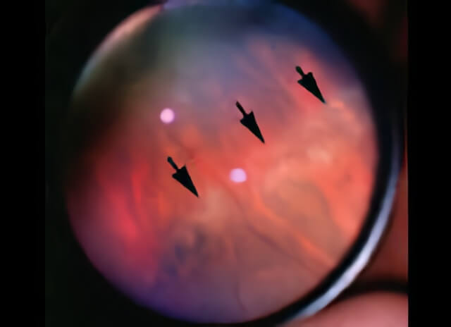 Lattice Degeneration Treatment | Retinal Consultants Medical Group