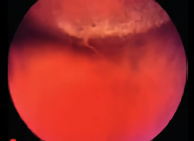 Lattice Degeneration Treatment | Retinal Consultants Medical Group