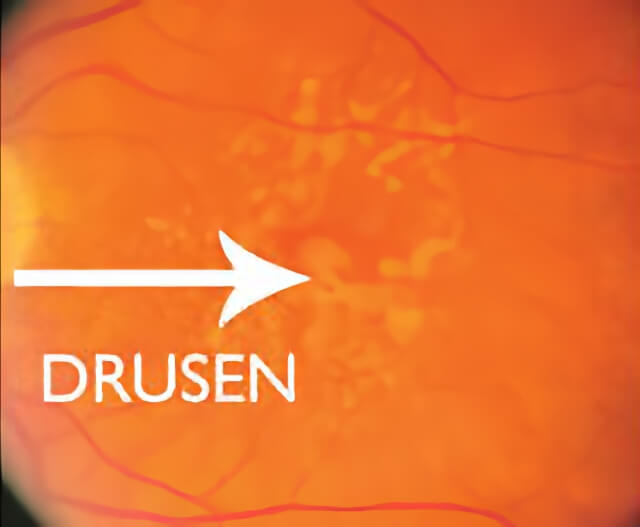 Macular Degeneration Treatment in Sacramento & Northern California | RCMG