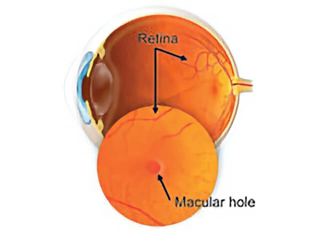 Macular Hole Treatment in Sacramento & Northern California | RCMG
