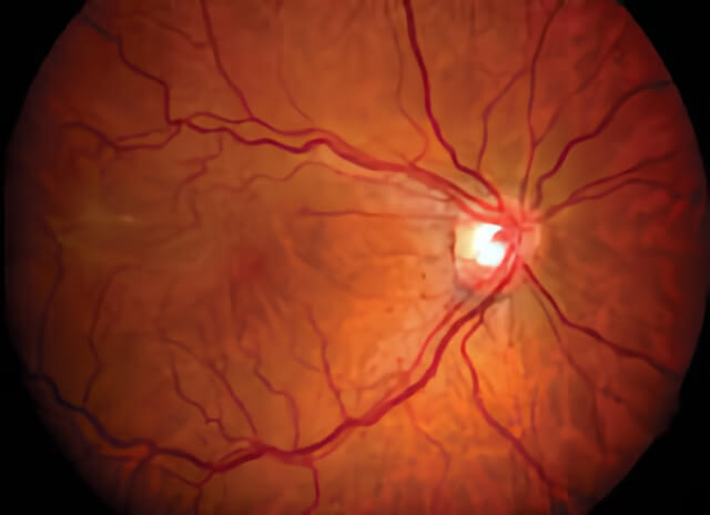 Macular Pucker Treatment | Retinal Consultants Medical Group