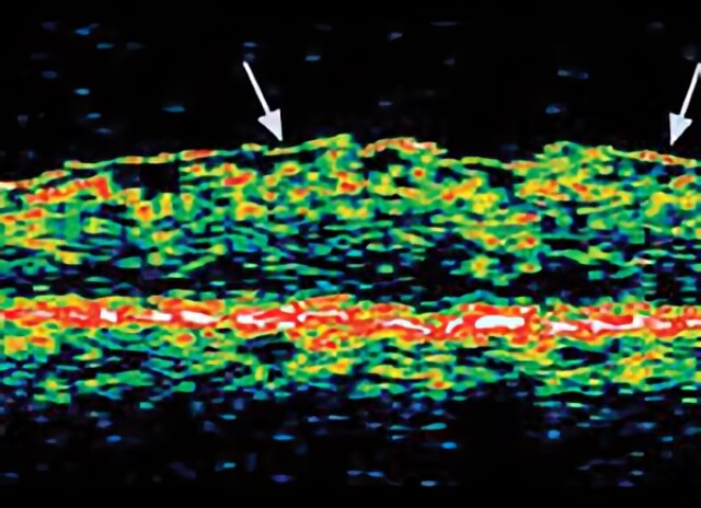 Macular Pucker Treatment | Retinal Consultants Medical Group
