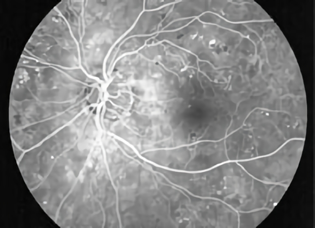 Nonproliferative Diabetic Retinopathy Icd 10