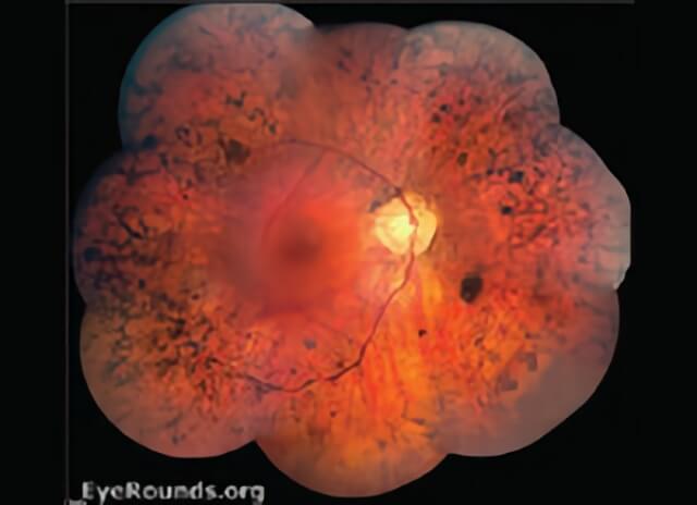 Retinitis Pigmentosa Treatment | Retinal Consultants Medical Group