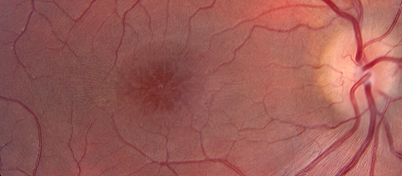 Retinal Photography | Retinal Consultants Medical Group